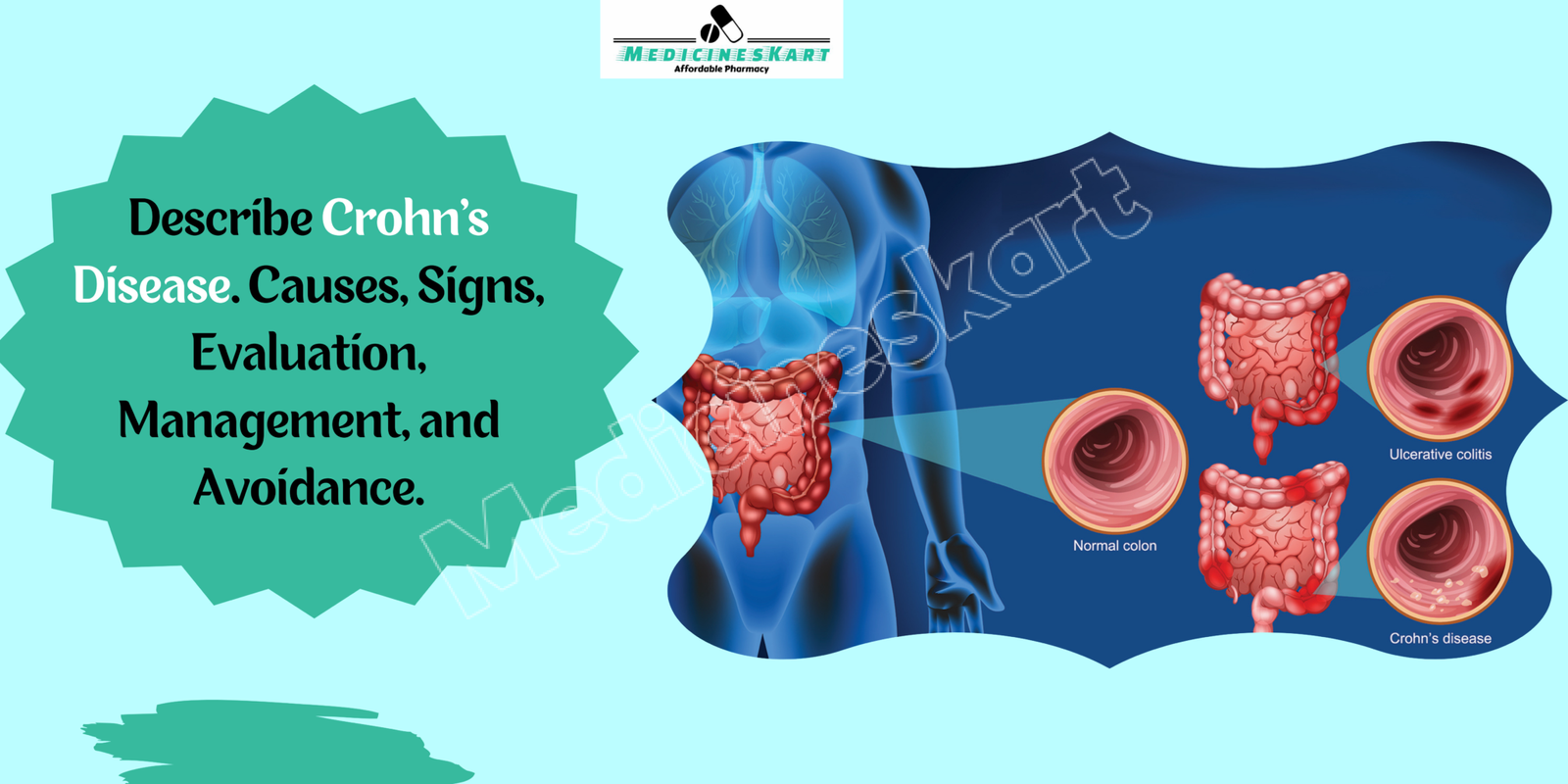 Describe Crohn's disease. Causes, Signs, Evaluation...